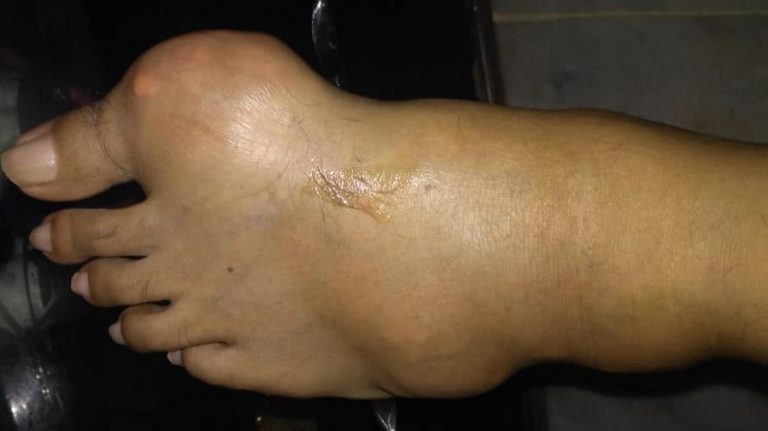 Punca dan penyebab penyakit ‘Gout’ | Denaihati